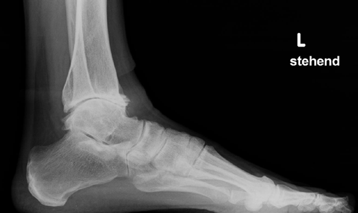 Endoprothetische Versorgung des oberen Sprunggelenkes - MVZ Wiesbaden