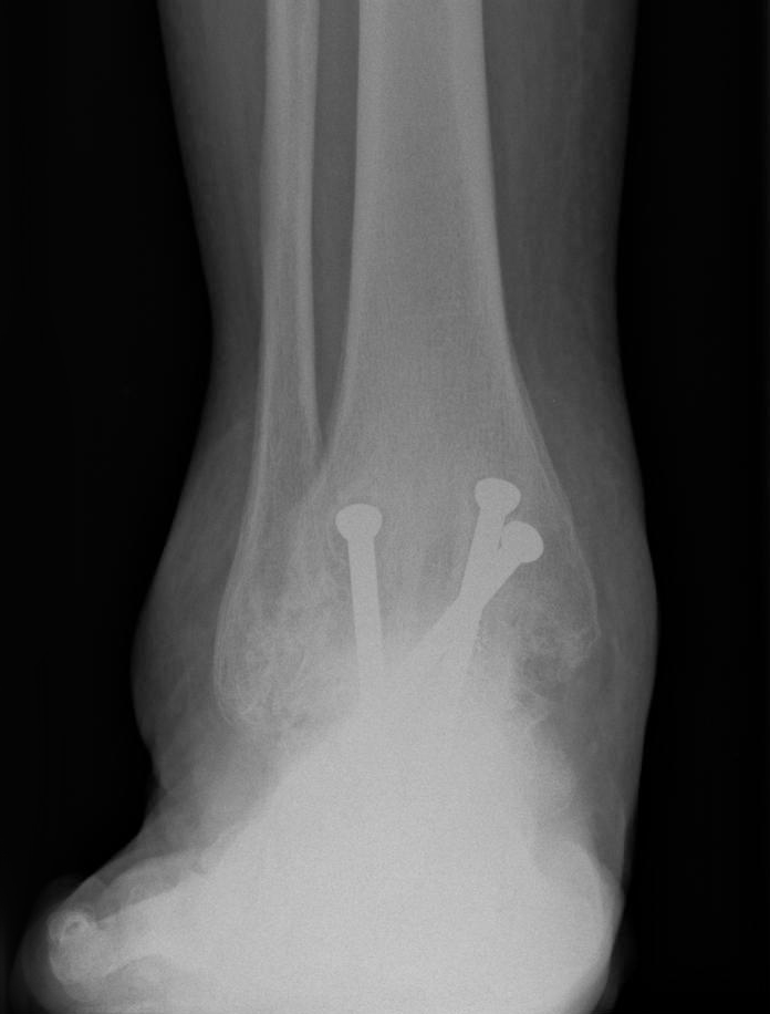 OSG-Prothese bei Z.n. Arthrodese - MVZ Wiesbaden