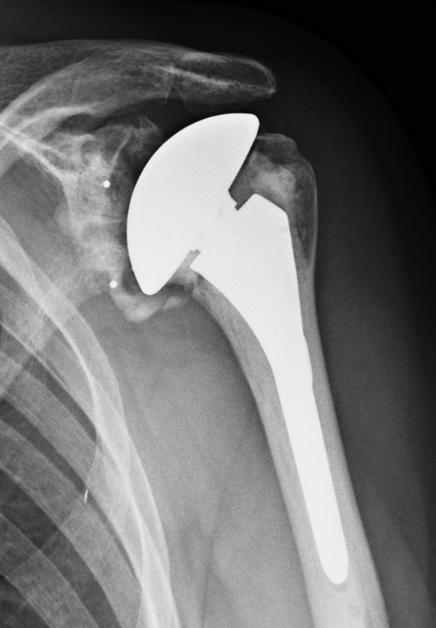 Schulterprothese bei schwerer Omarthrose - MVZ Wiesbaden