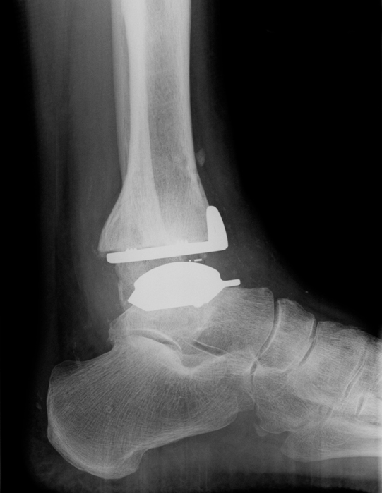 Arthrose des oberen Sprunggelenkes - MVZ Wiesbaden